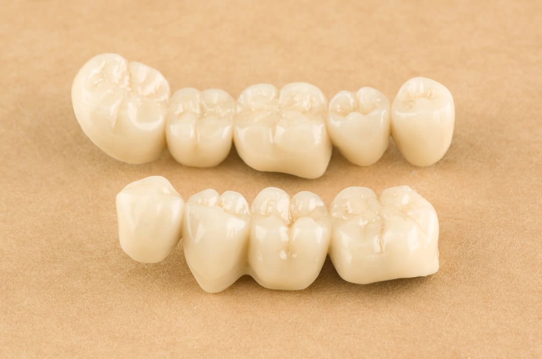 Bridges - Beyond Smiles Family Dental
