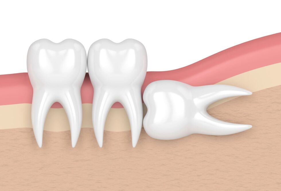 Wisdom Teeth - Beyond Smiles Family Dental